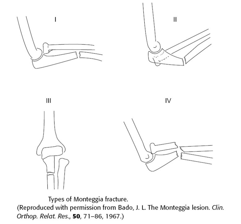 Bado’s Classification of Monteggia’s Fracture – Dr. Tushar Mehta